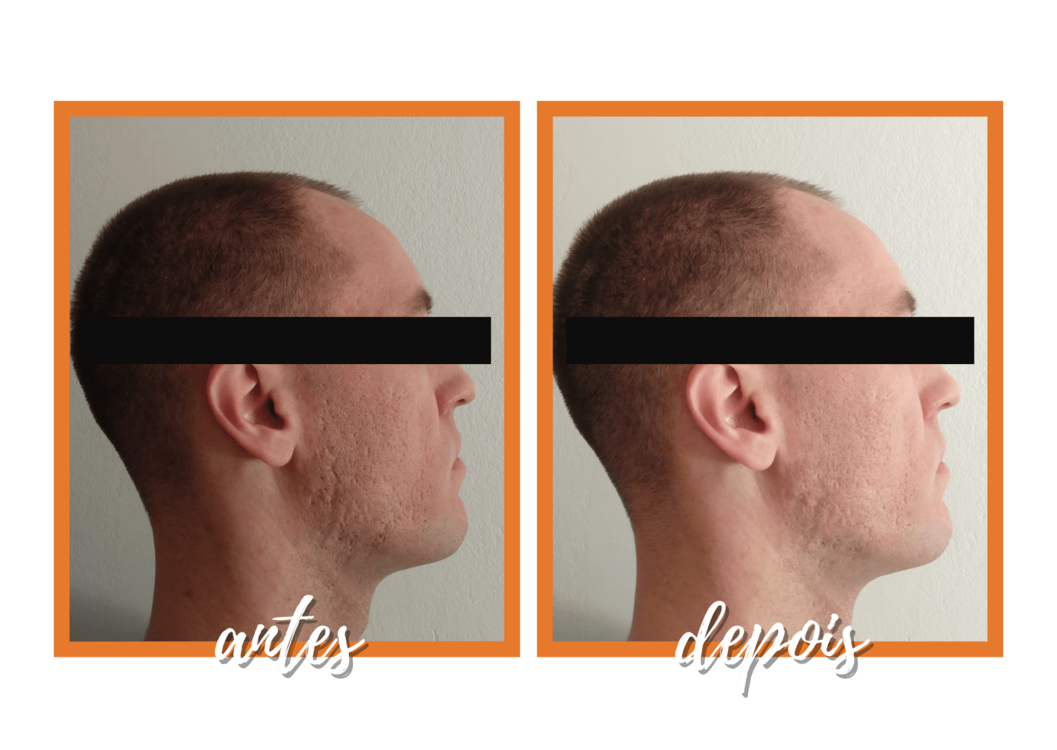 Cicatriz de Acne: Como tratar com Microagulhamento?