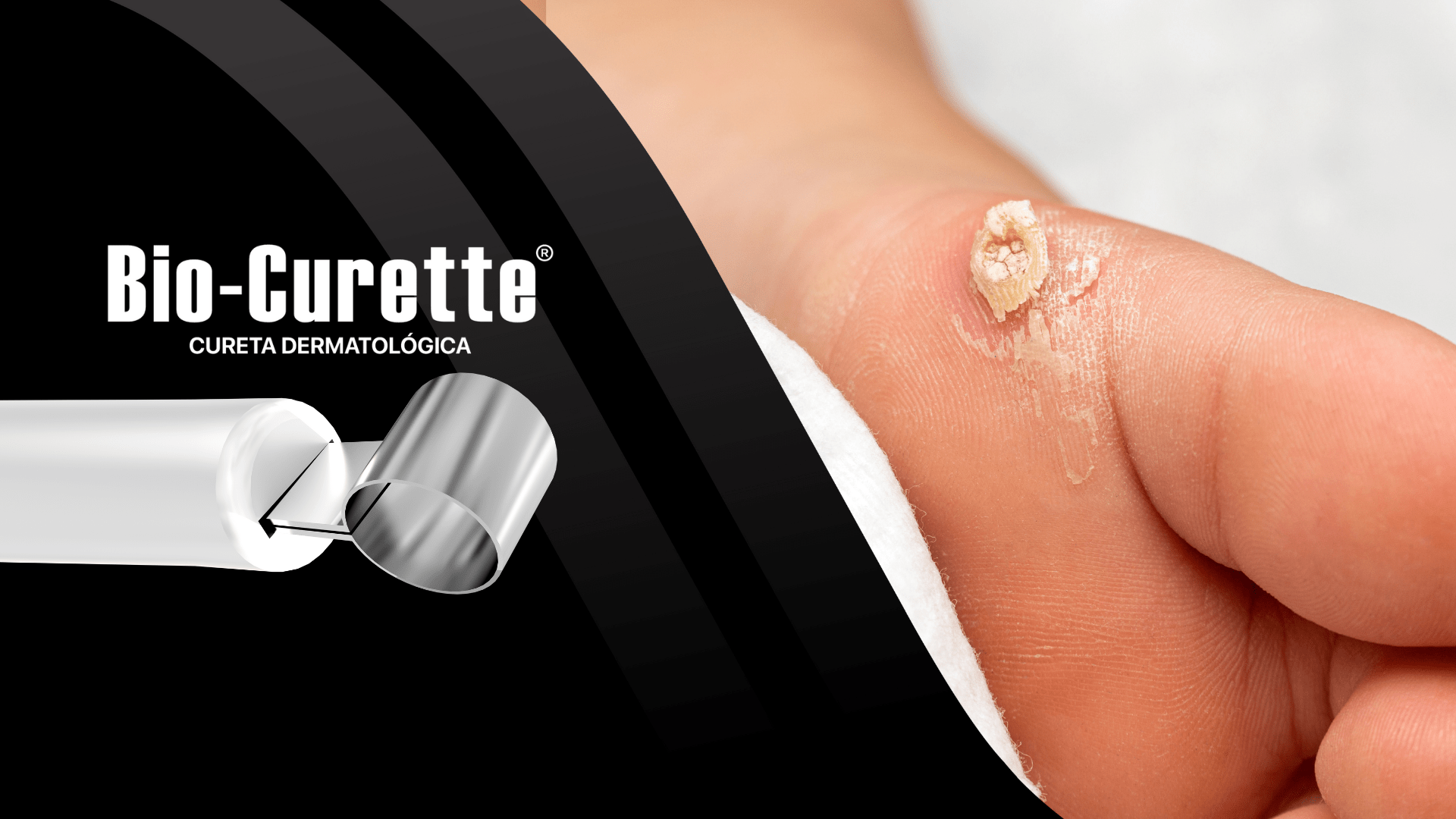 03 modelos da cureta dermatológica